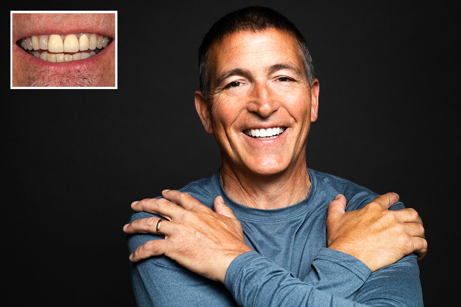 CASE STUDY: JIM - Freeman Smiles Cosmetic Dentistry Bend Oregon