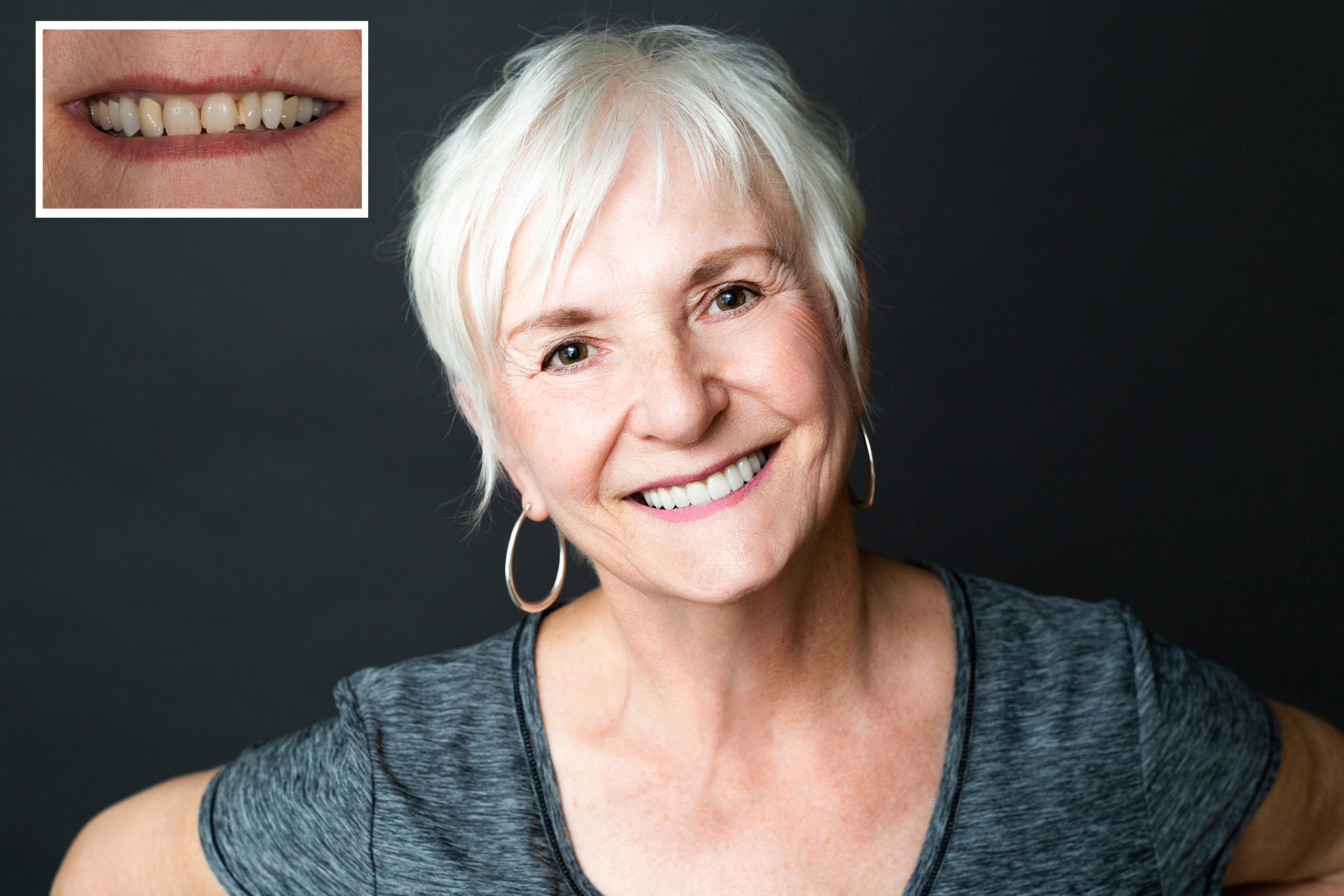 CASE STUDY: LESLIE - Freeman Smiles Cosmetic Dentistry Bend Oregon