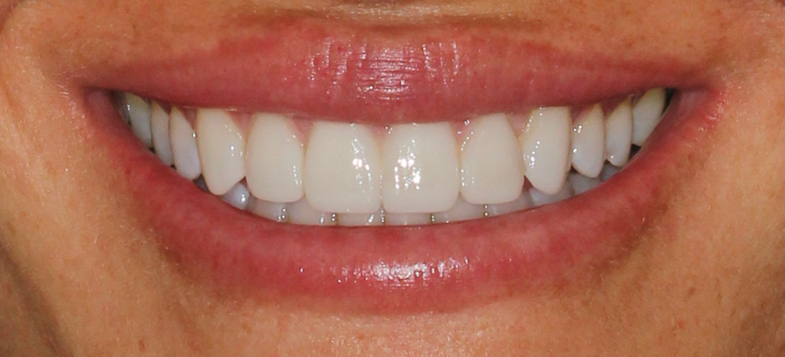CASE STUDY: JESSICA - Freeman Smiles Cosmetic Dentistry Bend Oregon
